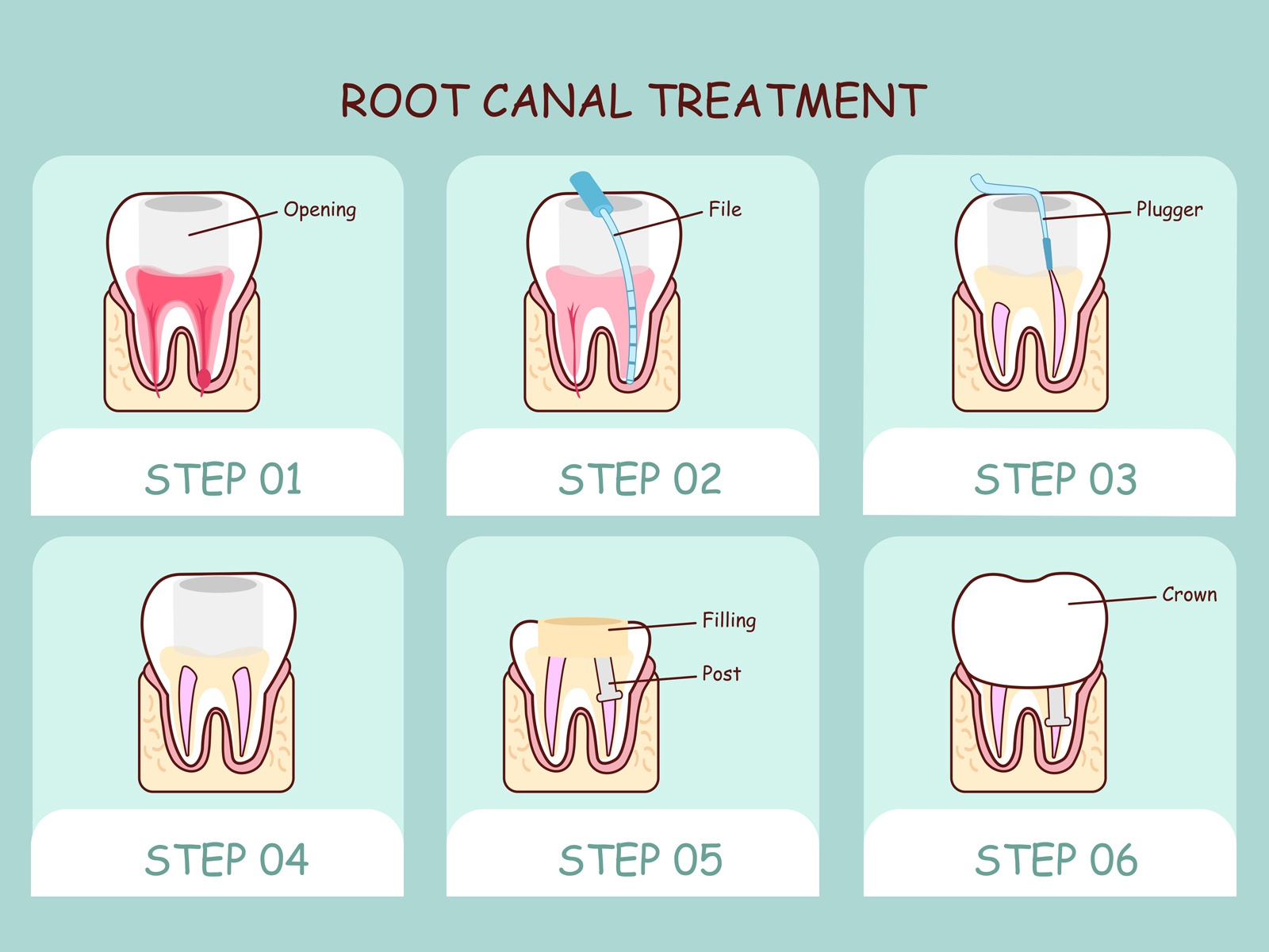 How Many Appointments Does A Root Canal Take